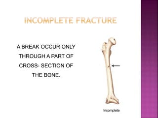 Fractures and types | PPTX