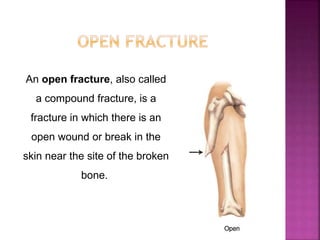 Fractures and types | PPTX