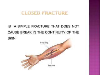 Fractures and types | PPTX