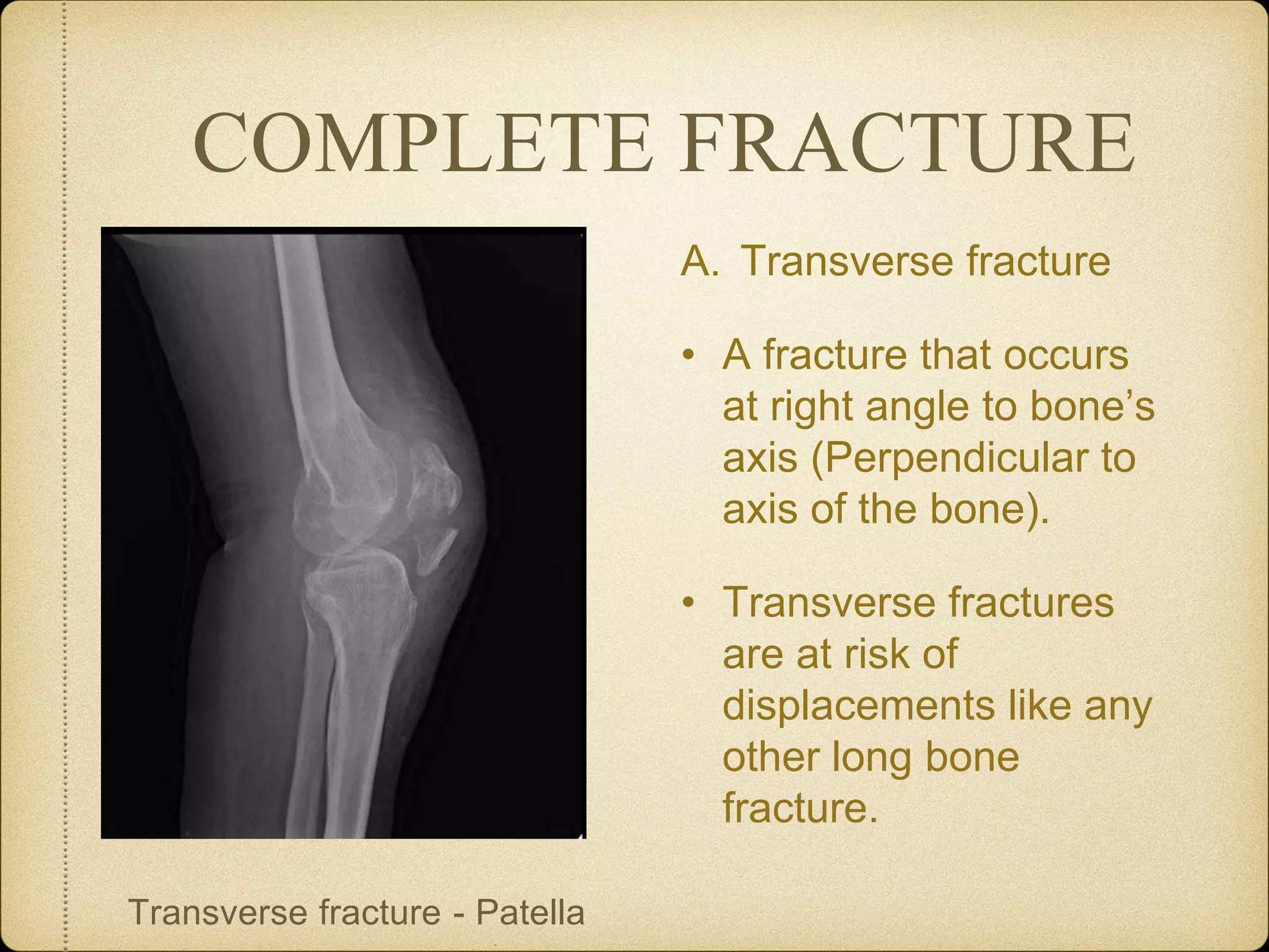 Fractures, types and lower extremities | PPTX