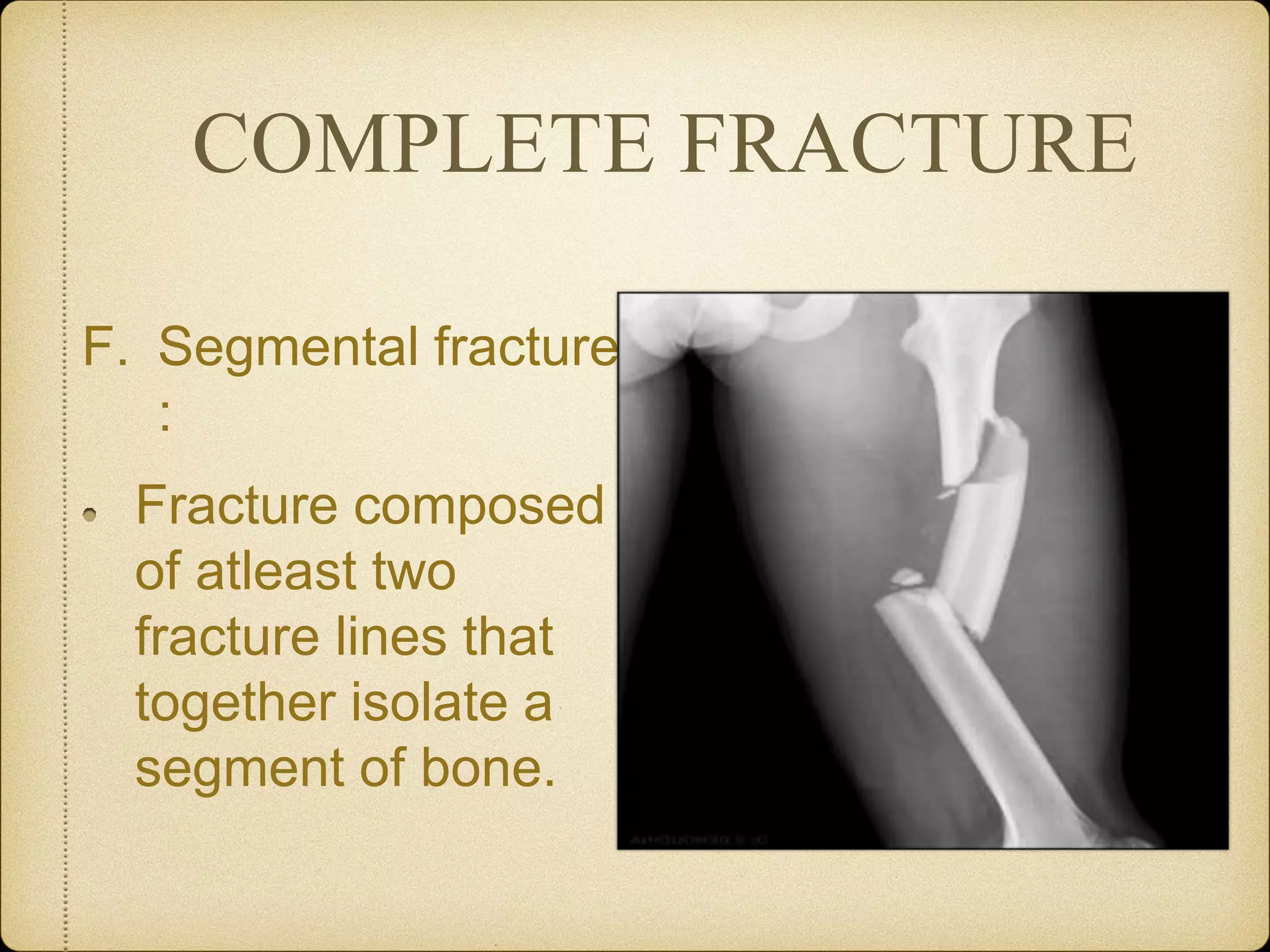 Fractures, types and lower extremities | PPTX