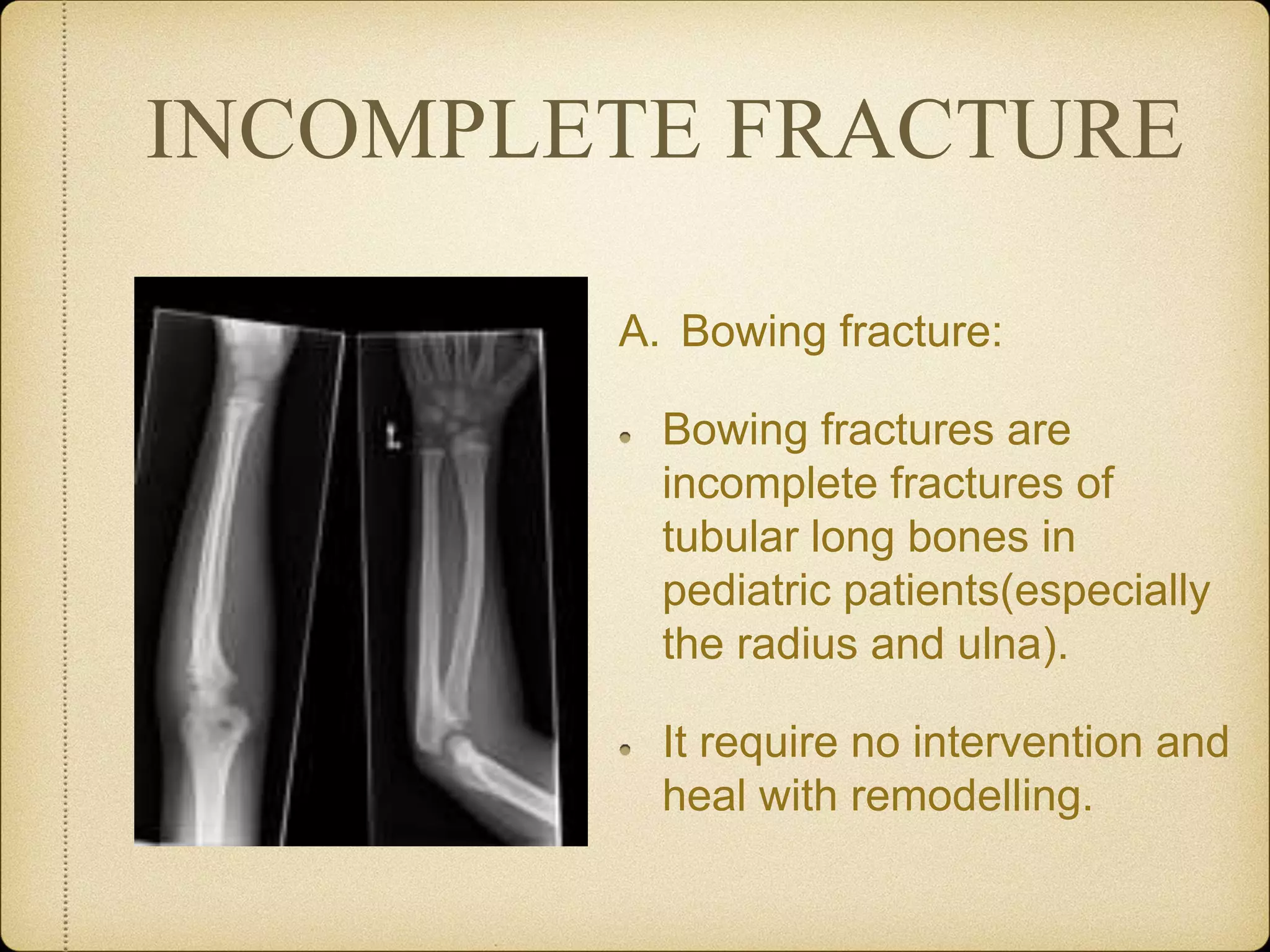 Fractures, types and lower extremities | PPTX