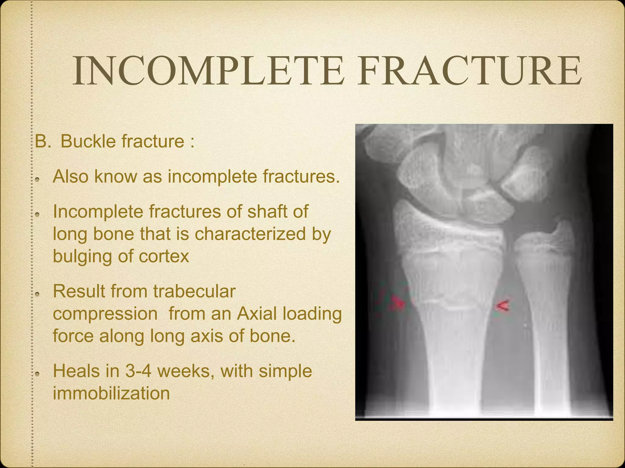 Fractures, types and lower extremities | PPTX