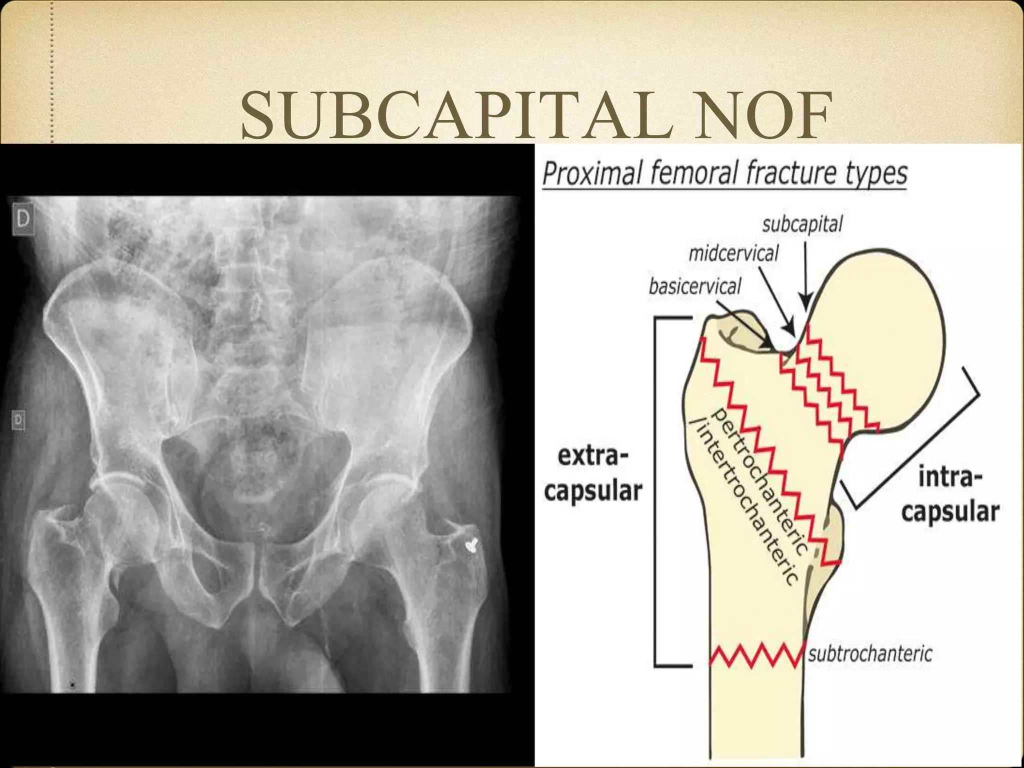 Fractures, types and lower extremities | PPTX