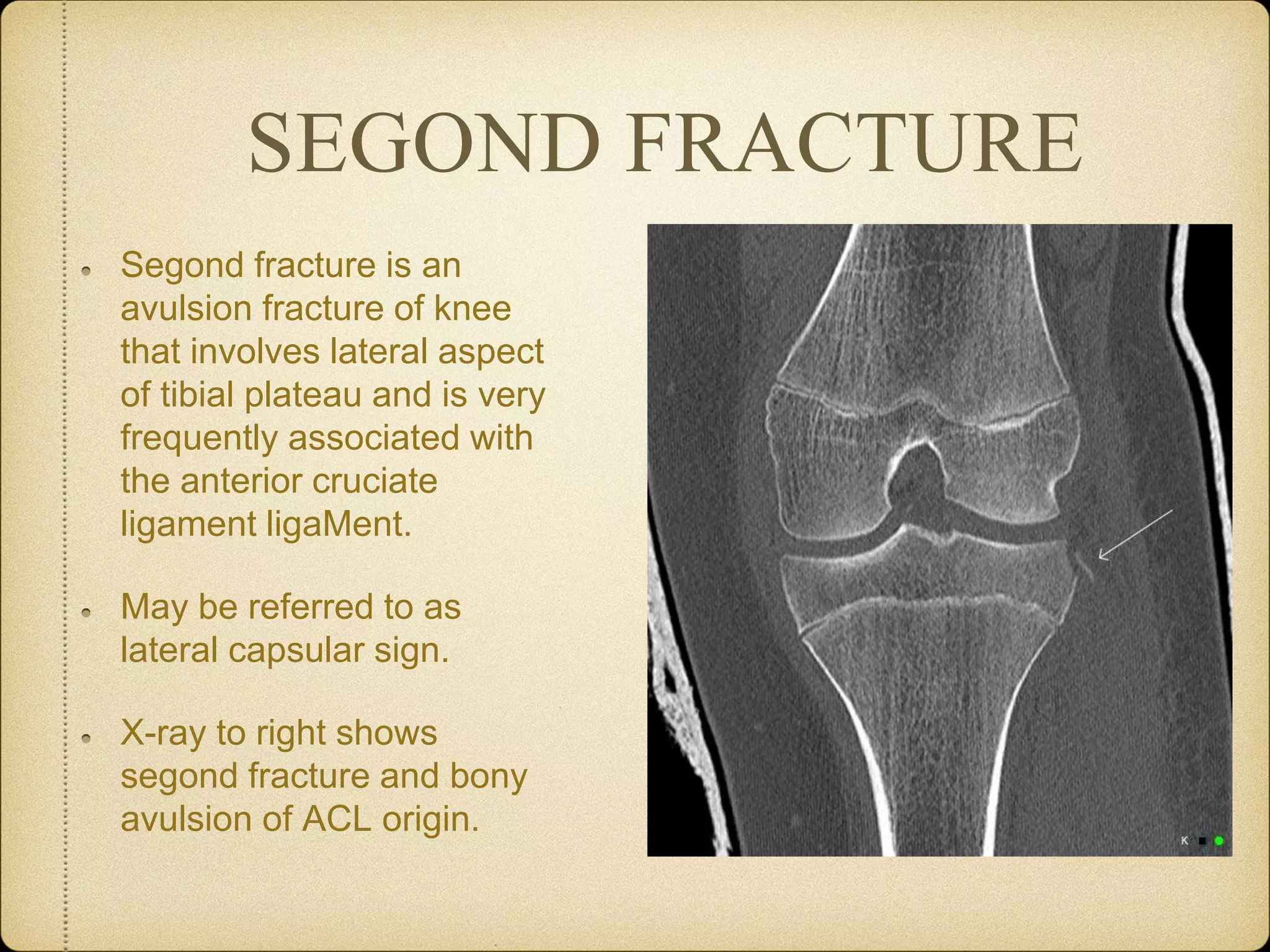 Fractures, types and lower extremities | PPTX