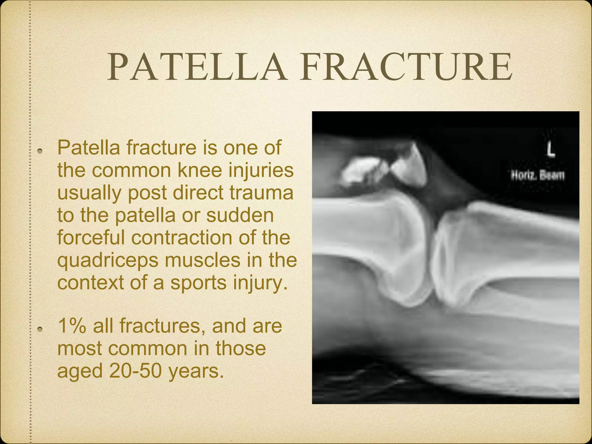 Fractures, types and lower extremities | PPTX