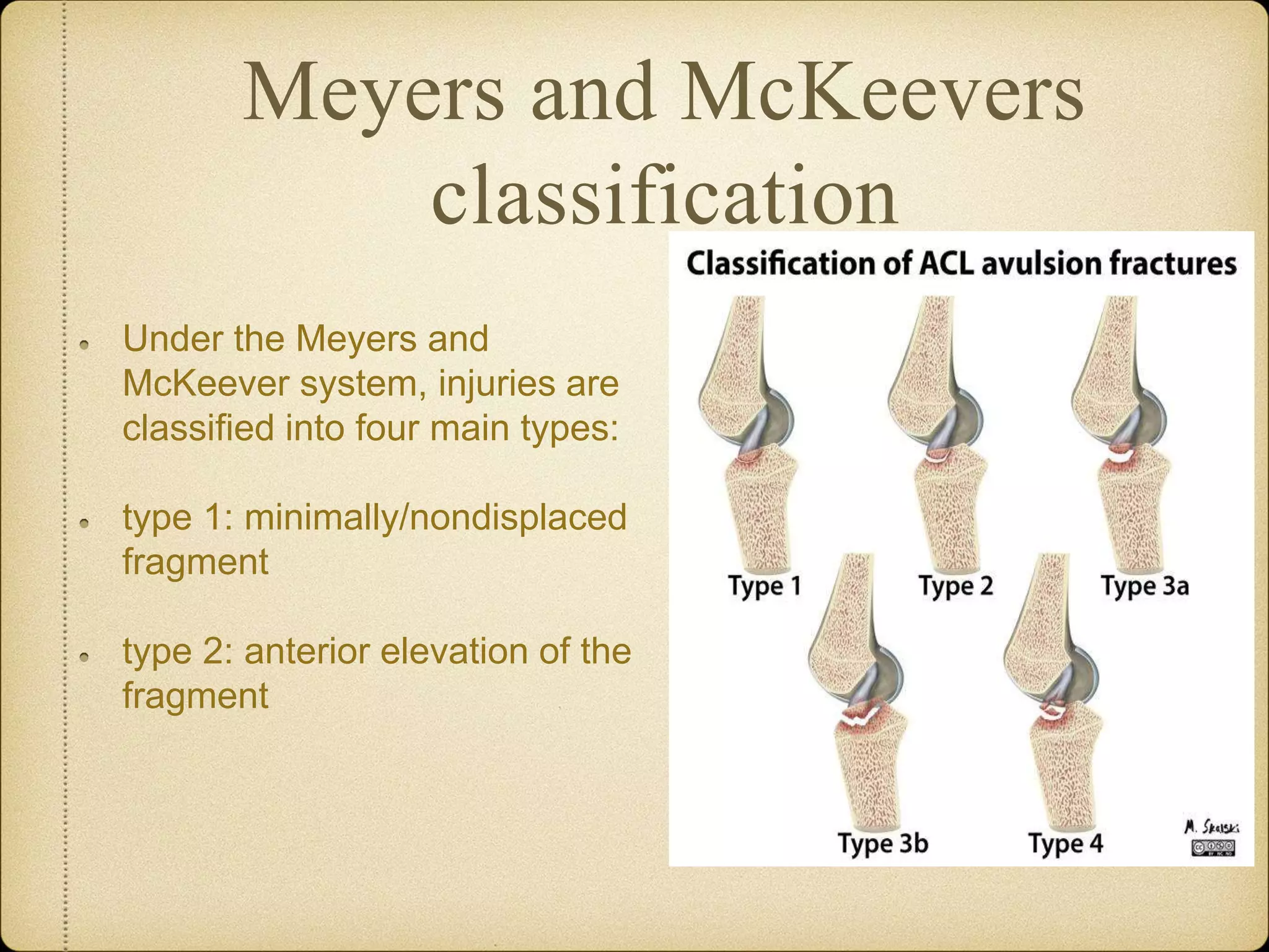 Fractures, types and lower extremities | PPTX