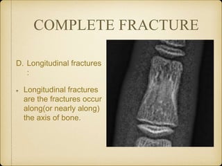 Fractures, types and lower extremities | PPTX