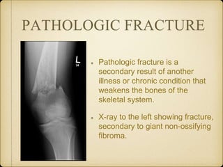 Fractures, types and lower extremities | PPTX