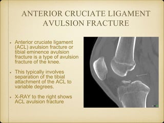 Fractures, types and lower extremities | PPTX