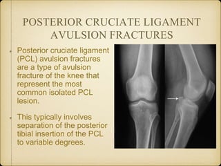 Fractures, types and lower extremities | PPTX