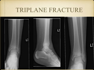 Fractures, types and lower extremities | PPTX
