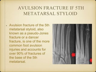 Fractures, types and lower extremities | PPTX