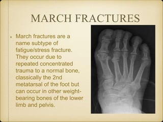 Fractures, types and lower extremities | PPTX