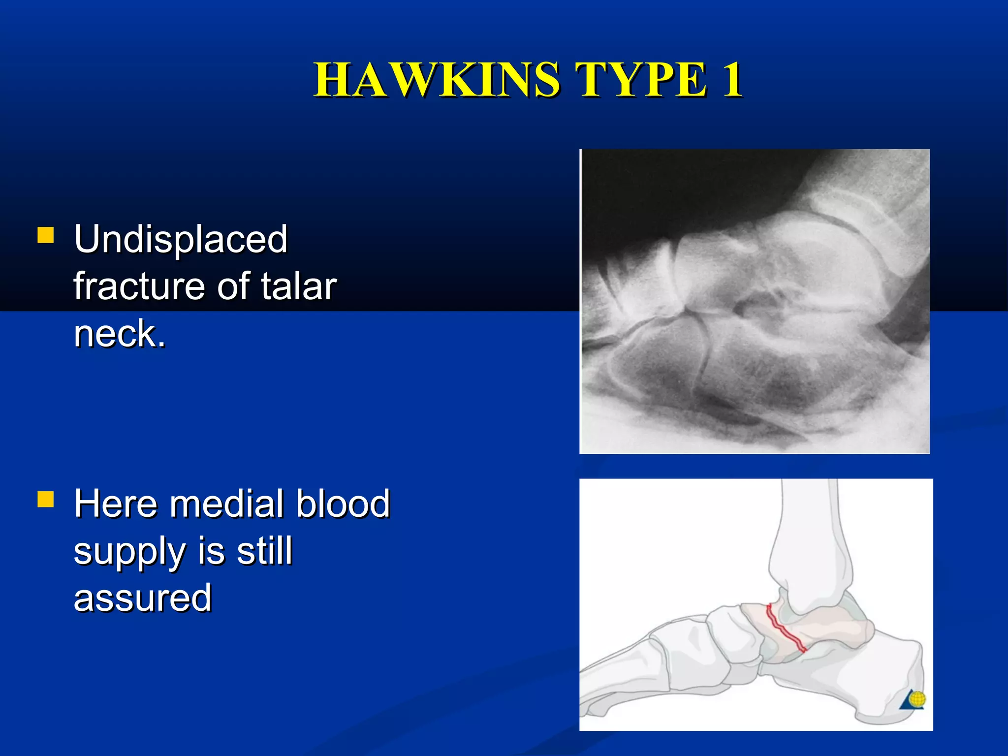 Fracture Talus | PPT