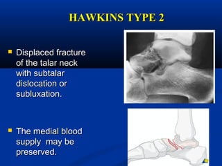 Fracture Talus | PPT