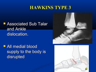 Fracture Talus | PPT