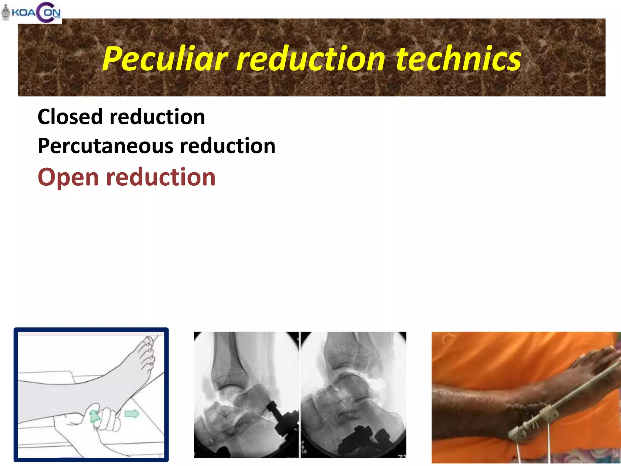 Fracture talus surgical options-dr mohamed ashraf-hod orthopaedics govt ...
