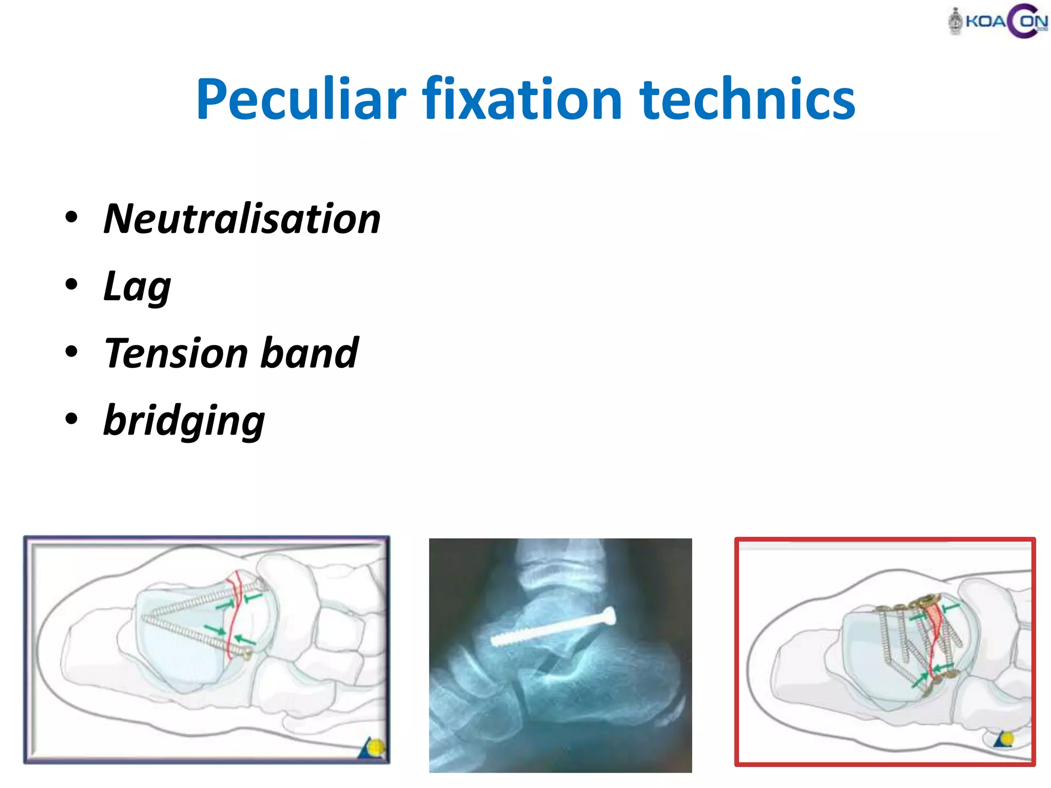 Fracture talus surgical options-dr mohamed ashraf-hod orthopaedics govt ...