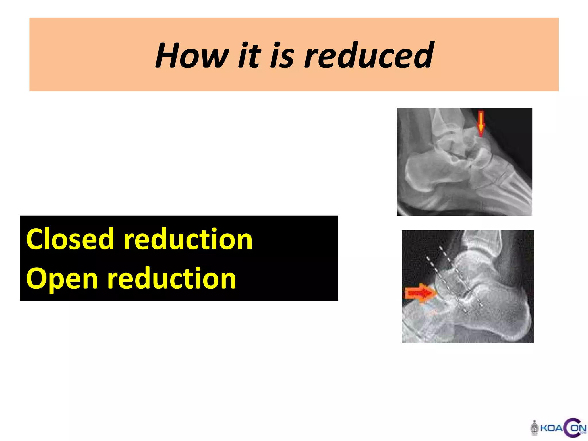 Fracture talus surgical options-dr mohamed ashraf-hod orthopaedics govt ...