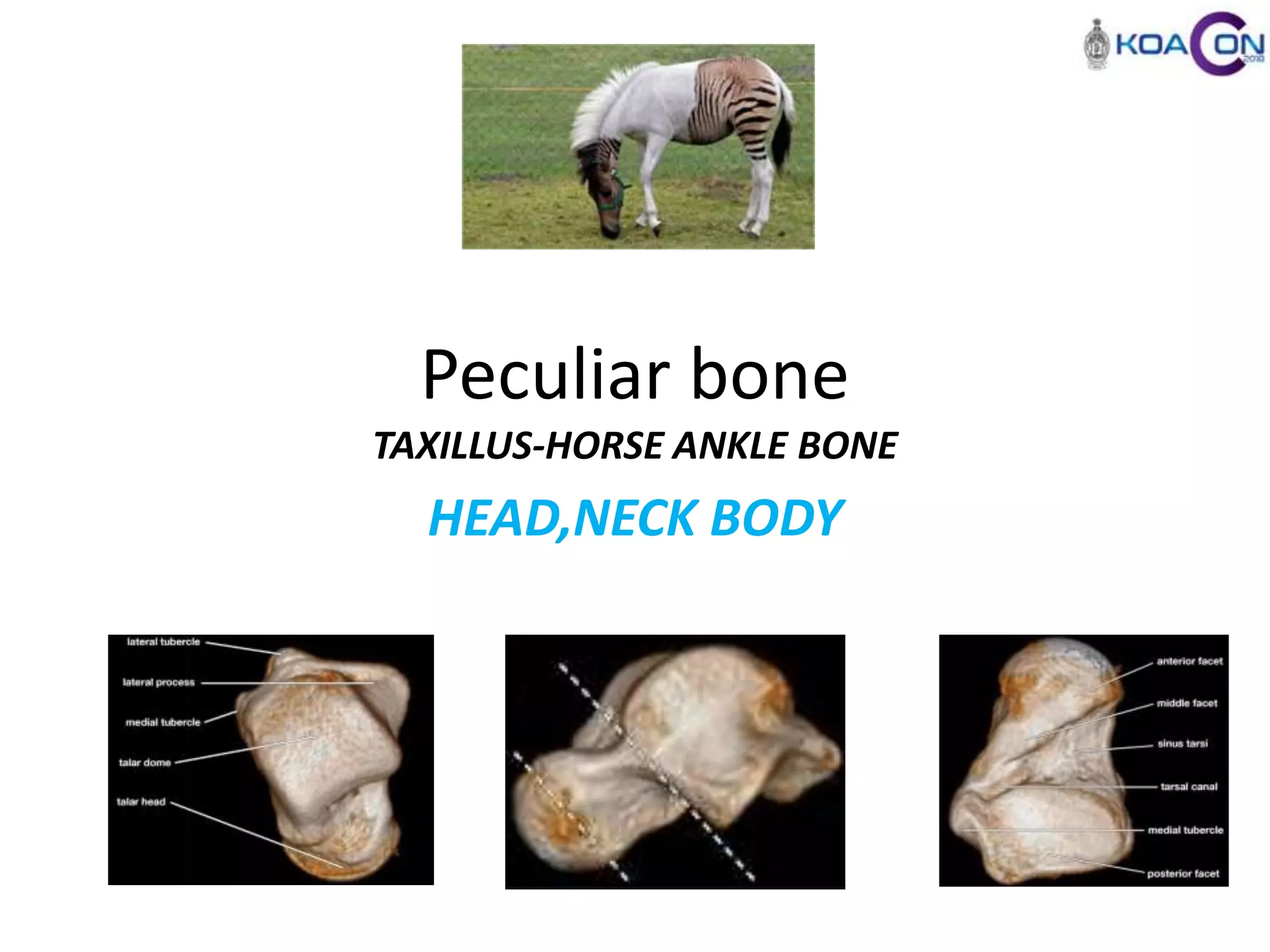 Fracture talus surgical options-dr mohamed ashraf-hod orthopaedics govt ...