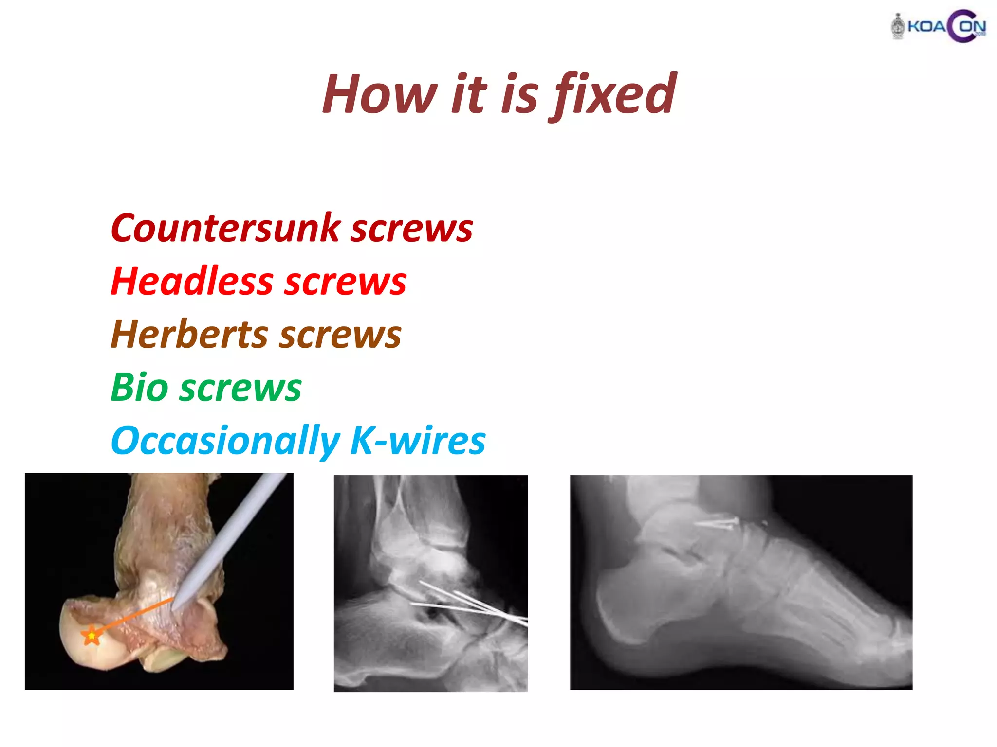 Fracture talus surgical options-dr mohamed ashraf-hod orthopaedics govt ...