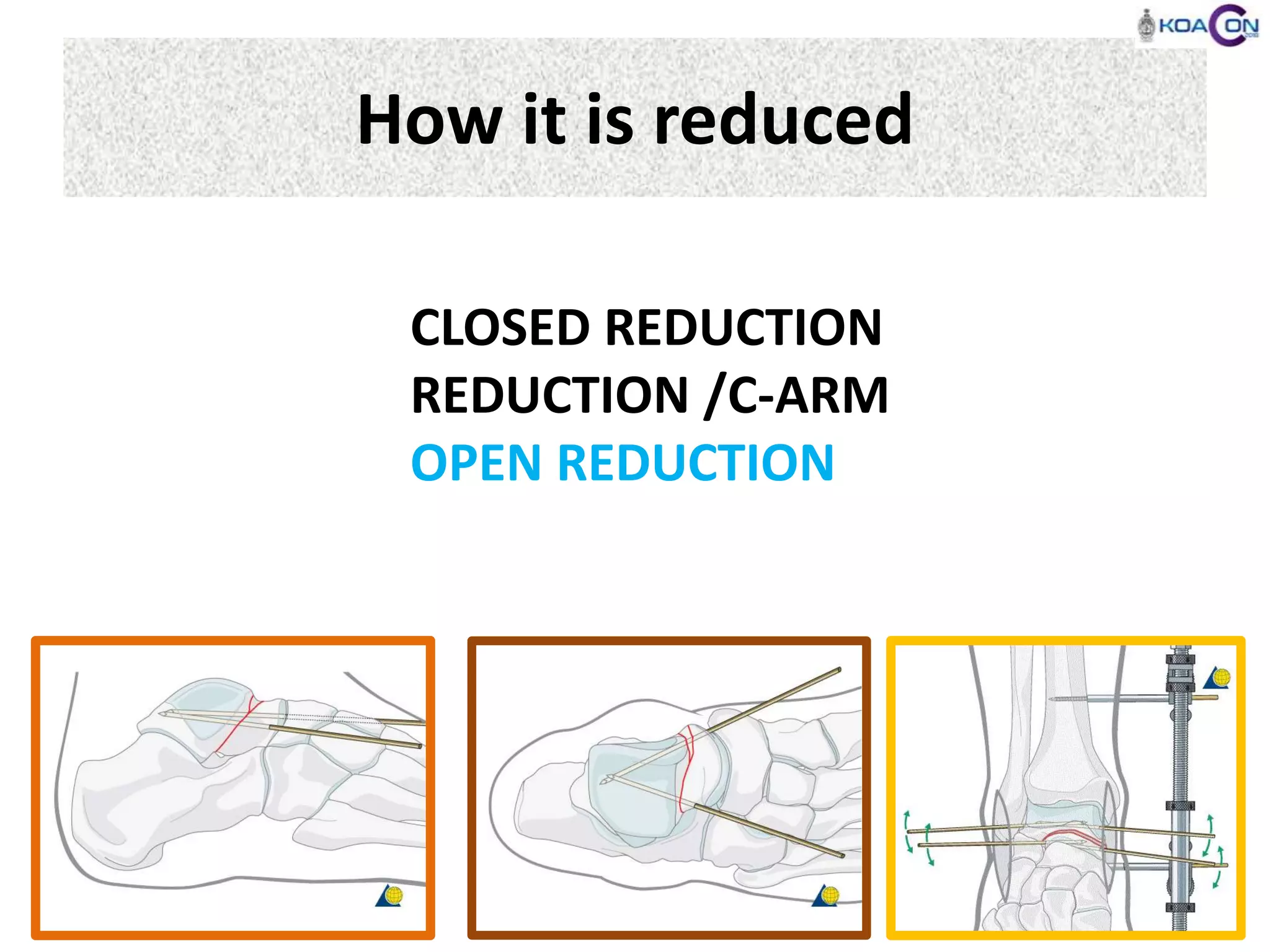 Fracture talus surgical options-dr mohamed ashraf-hod orthopaedics govt ...