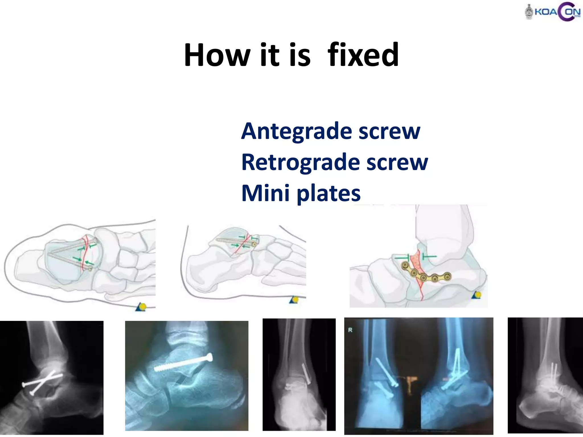 Fracture talus surgical options-dr mohamed ashraf-hod orthopaedics govt ...