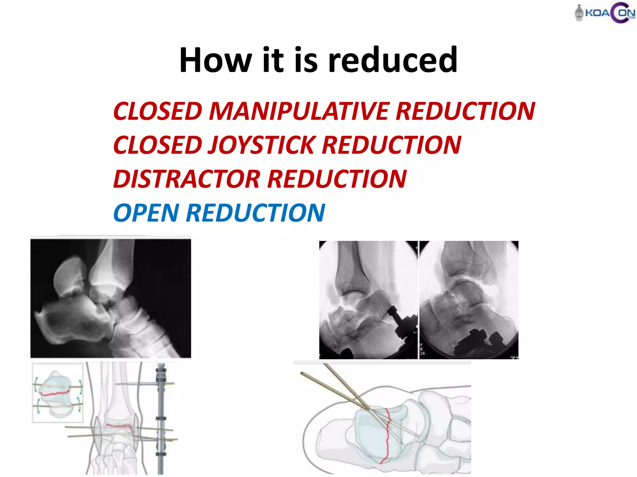 Fracture talus surgical options-dr mohamed ashraf-hod orthopaedics govt ...