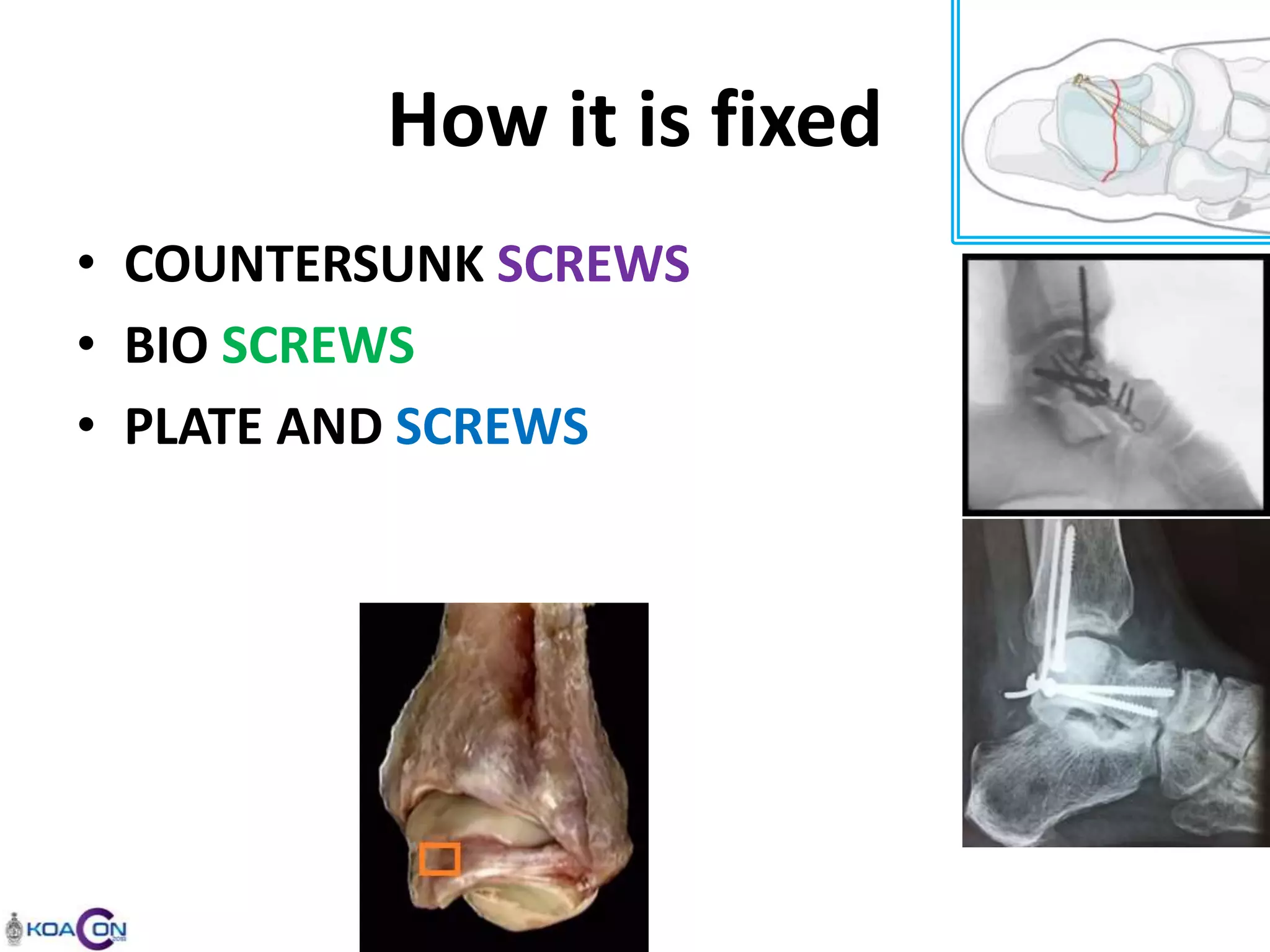 Fracture talus surgical options-dr mohamed ashraf-hod orthopaedics govt ...