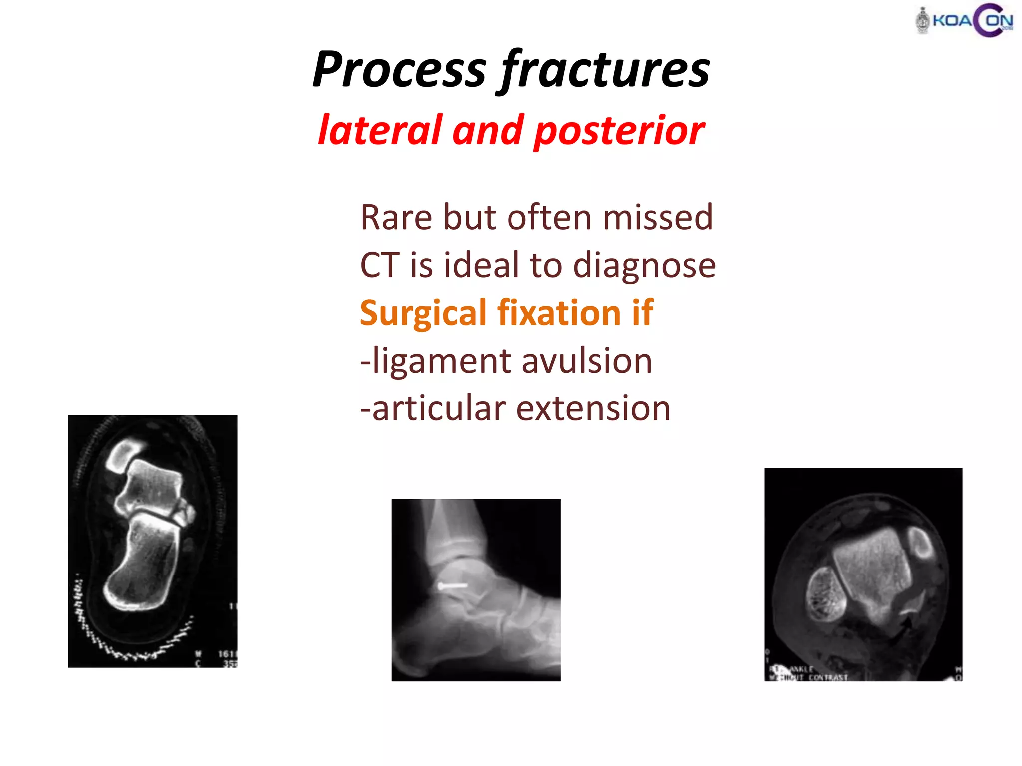 Fracture talus surgical options-dr mohamed ashraf-hod orthopaedics govt ...
