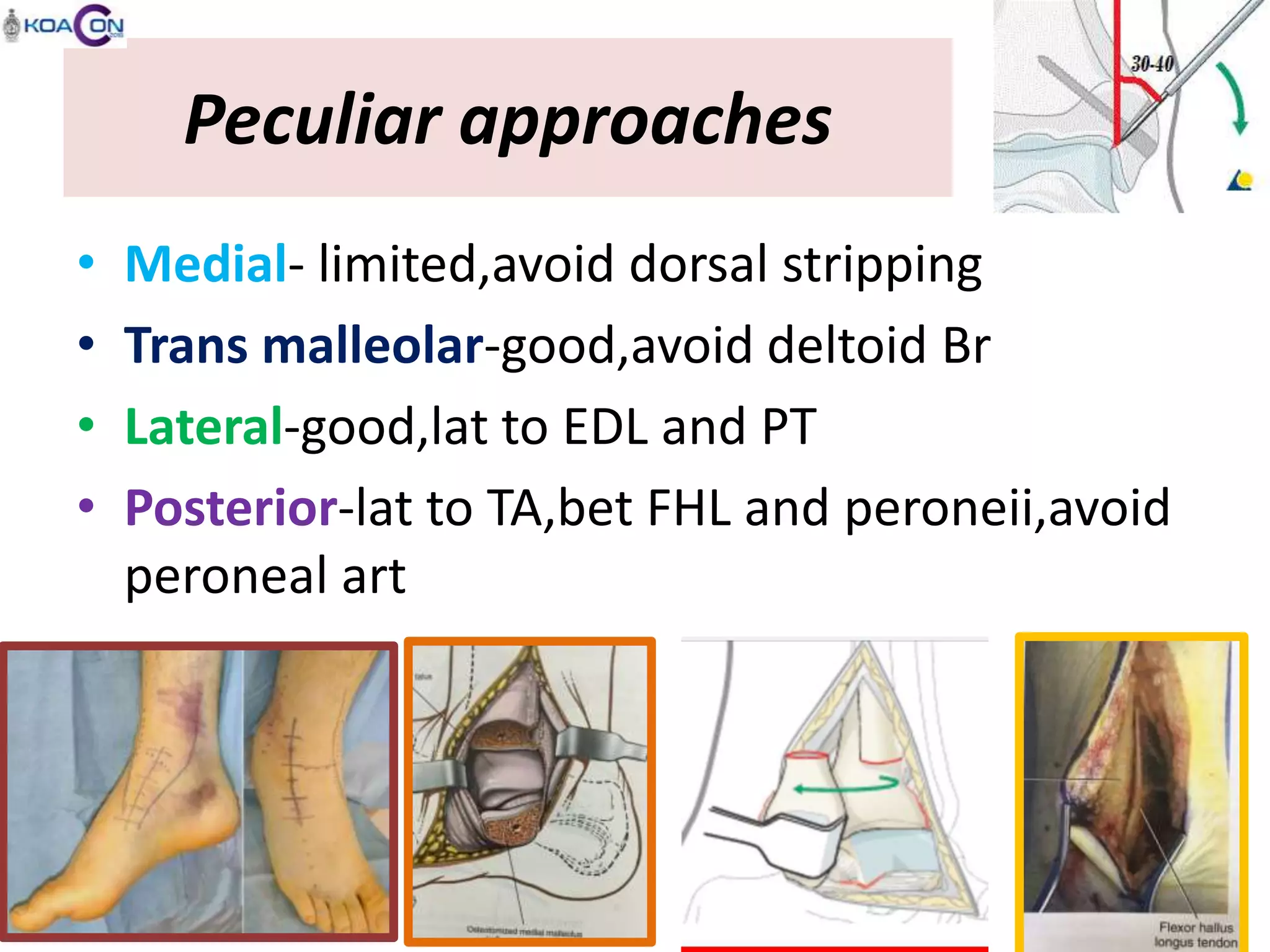 Fracture talus surgical options-dr mohamed ashraf-hod orthopaedics govt ...
