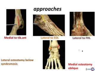 Fracture talus surgical options-dr mohamed ashraf-hod orthopaedics govt ...