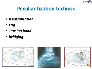 Fracture talus surgical options-dr mohamed ashraf-hod orthopaedics govt ...