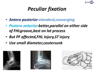 Fracture talus surgical options-dr mohamed ashraf-hod orthopaedics govt ...