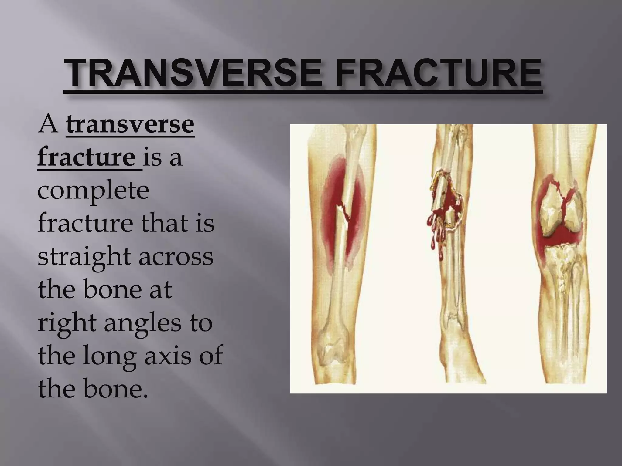 Bone Fracture Types by Nadia Abdulallah | PPTX