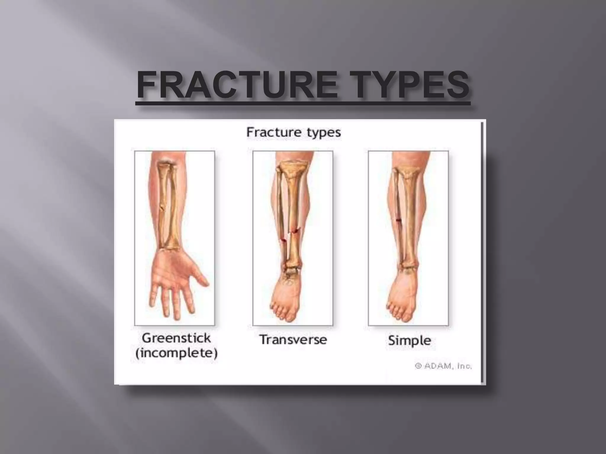 Bone Fracture Types by Nadia Abdulallah | PPT