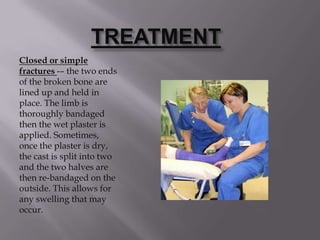 Bone Fracture Types by Nadia Abdulallah | PPTX