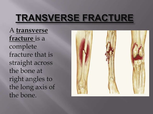 Bone Fracture Types by Nadia Abdulallah | PPT