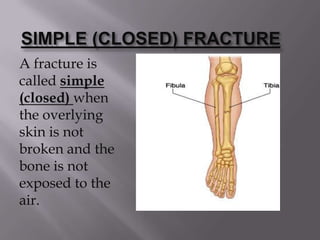 Bone Fracture Types by Nadia Abdulallah | PPTX