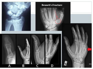 basic orthopaedic trauma | PPTX