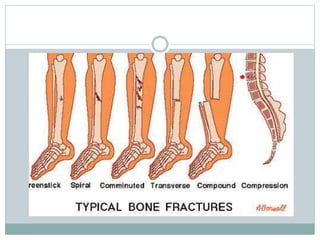 basic orthopaedic trauma | PPTX