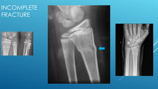FRACTURE X RAY INTERPRETATION FOR MEDICAL STUDENTS.ppt