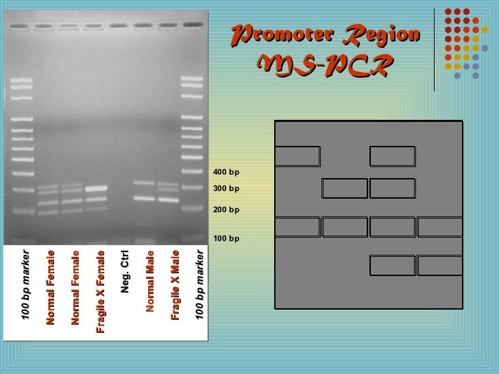 Fragile X Syndrome Mutation By Methylation Sensitive Pcr