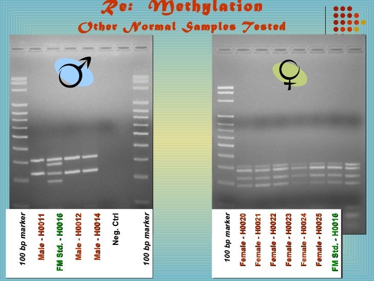 Fragile X Syndrome Mutation By Methylation Sensitive Pcr