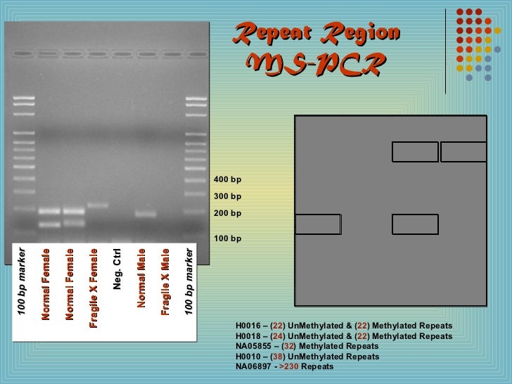 Fragile X Syndrome Mutation By Methylation Sensitive Pcr