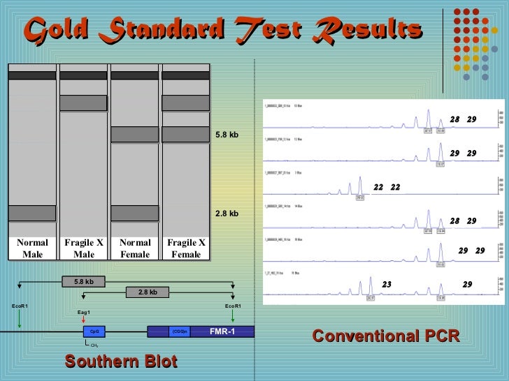 Fragile X Syndrome Mutation By Methylation Sensitive Pcr