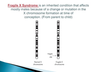 Fragile x syndrome | PPTX