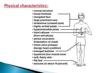 Fragile x syndrome | PPTX