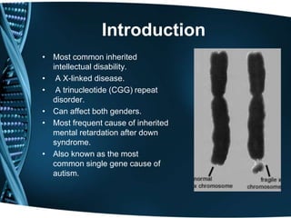 Fragile x syndrome | PPTX